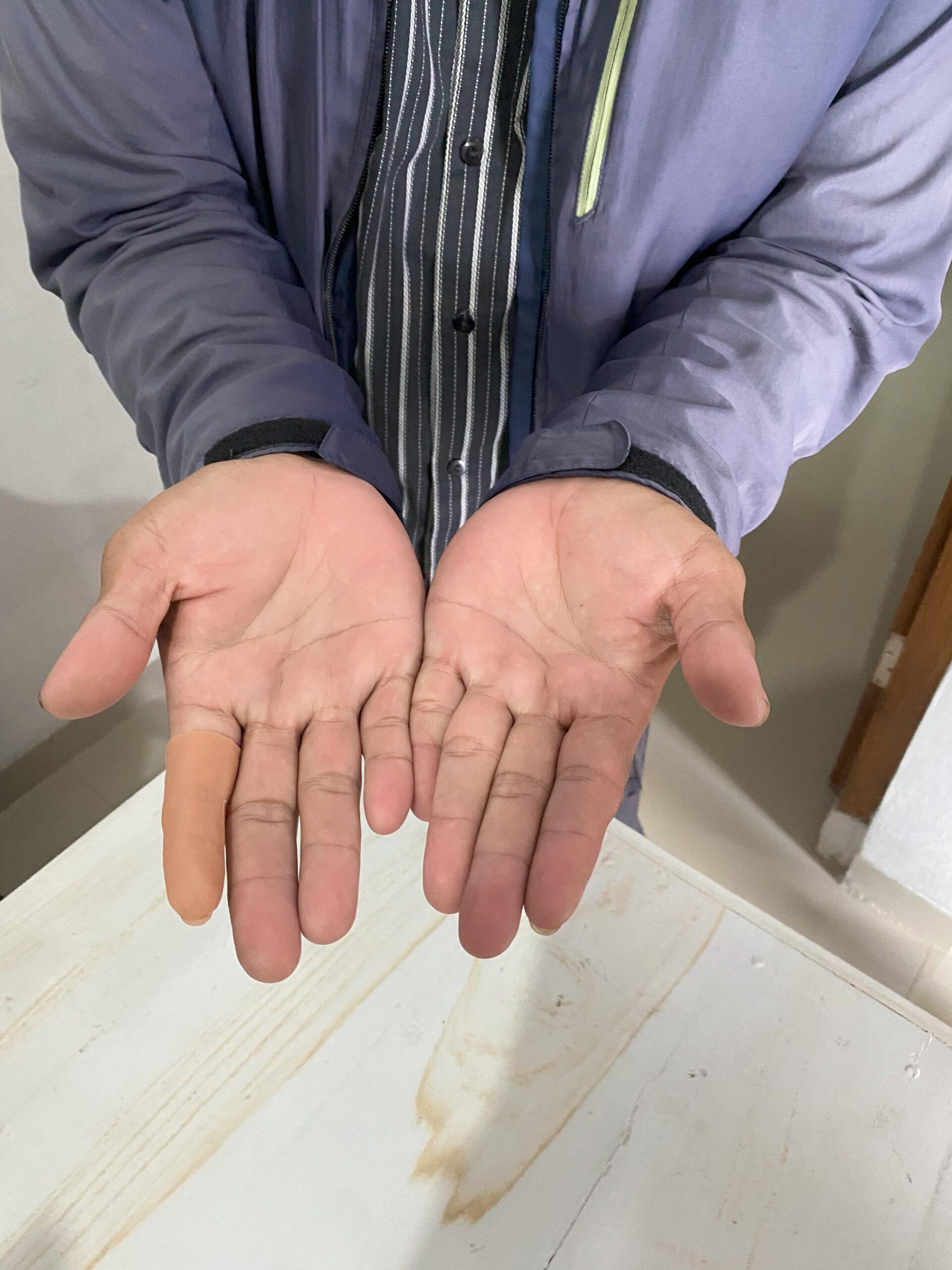 Collaborative Innovation Project in Making Prosthetic Fingers ...